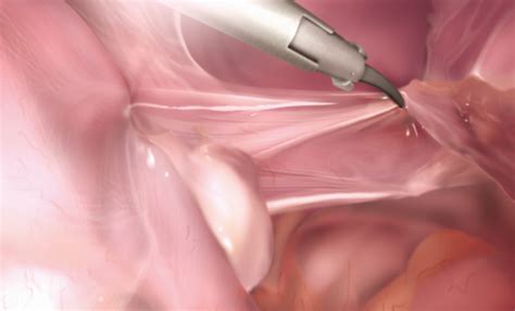 Ultrasonic Scalpel Comprehensive Usage And Maintenance Guidelines 233 Henan Trading Co Ltd