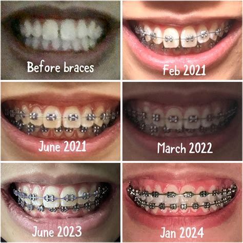 Teeth Progressions 3 Years Rbraces