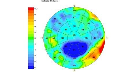 Blog Epithelial Mapping Enhances Keratoconus Detection Monitoring