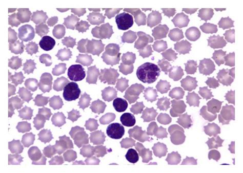 Adult T‐cell Leukemialymphoma With Cll‐like Morphology—a Case Report