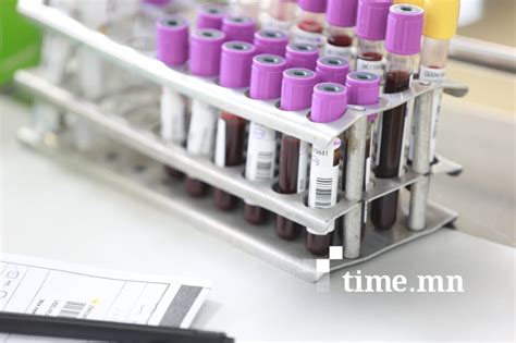 Тэмбүү өвчнөөс болж 1 хүн нас баржээ