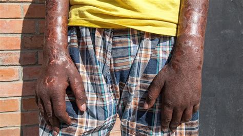 Heres What To Know About Leprosy In Florida