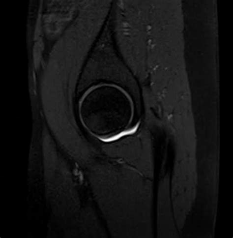 Plan Arthrogram Hip T1 Fat Sat Sagittal Mrimaster