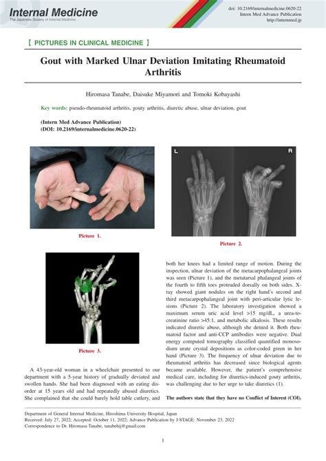 Pdf Gout With Marked Ulnar Deviation Imitating Rheumatoid Arthritis