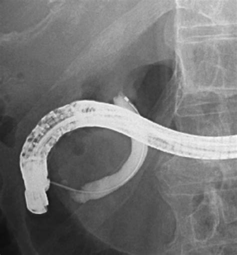 Cholangiography Showing Common Bile Duct Disruption Figure 3 Magnetic Download Scientific