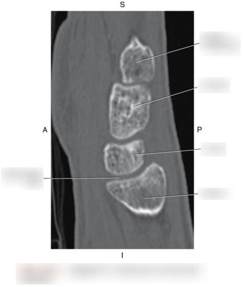 Sg Ct Wrist Diagram Quizlet