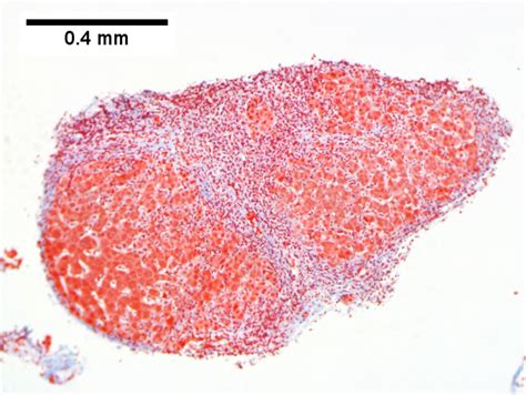 Hepatitis B Libre Pathology