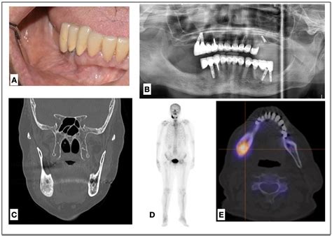 Chronic Diffuse Sclerosing Osteomyelitis Of The Mandible The Use Of