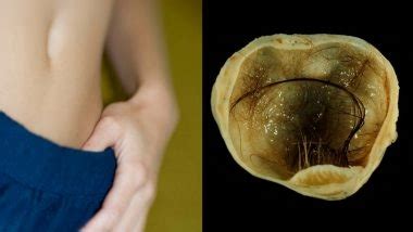 Hair Bones And Teeth Inside Ovarian Cyst What Exactly Is A Dermoid
