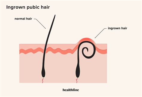 Ingrown Hair Pictures How To Get Rid Of Ingrown Hair