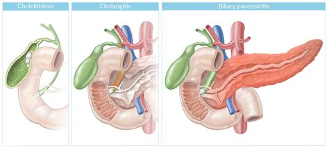 Choledocholithiasis Vs Cholelithiasis