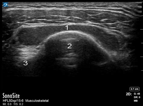 Shoulder Transverse Subacromial Bursitis Image Sonosite Institute For