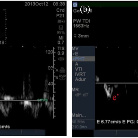 Before Ultrafiltration A Mitral Inflow Doppler Measuring Early