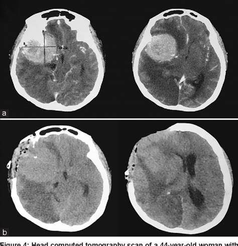 Figure 3 From Lifesaving Decompressive Craniectomy For High Intracranial Pressure Attributed To