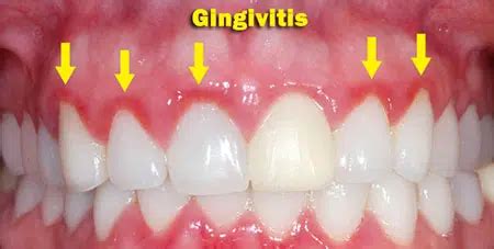 Bleeding Gums Causes And Prevention Tips