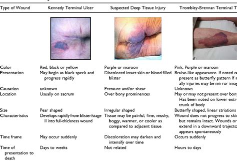 Kennedy Terminal Ulcer Stages At Elmer Holt Blog