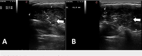 Figure 2 From Extraskeletal Ewings Sarcoma With Vertebral Metastasis A Case Report Semantic