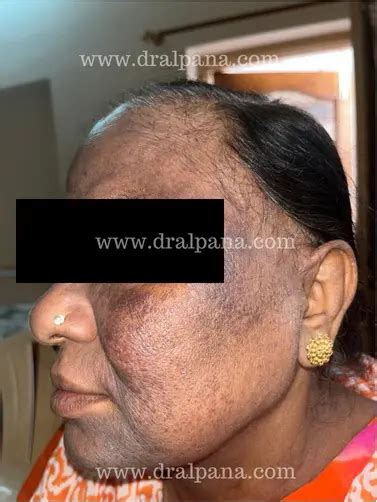 How To Reduce Excess Melanin Caused By Hyperpigmentation A