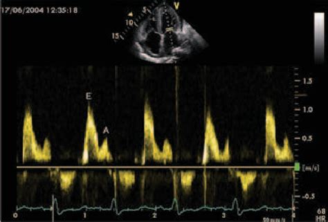 Transmitral Doppler Flow Showed A Restrictive Filling Pattern With Ea Download Scientific