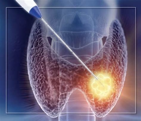 What You Need To Know About Thyroid Cyst