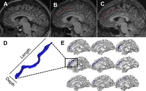 Variability In Paracingulate Sulcus Pcs Morphology The Pcs May Be Download Scientific