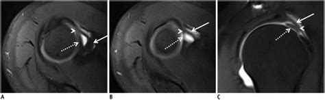 Supraglenoid Tubercle