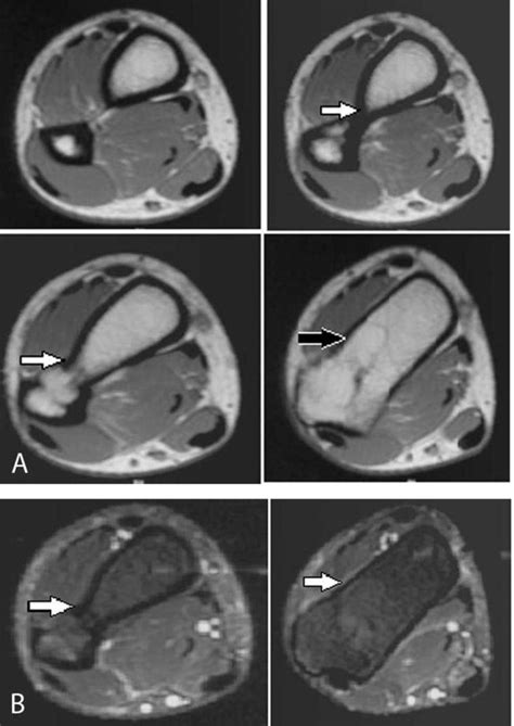 Congenital Distal Tibiofibular Synostosis Pmc