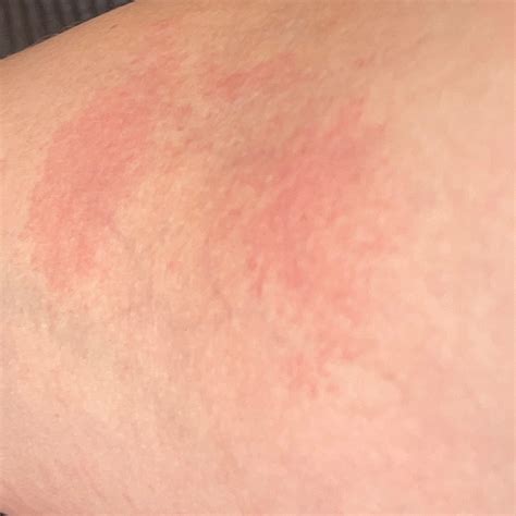 Dermatitis Icd 10 L20 L30 Online Consultation Ai Dermatologist