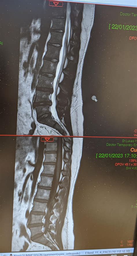 So Chronic Sciatica For The Last 5 Years F29 I Have Been Told By The Msk Specialist That I