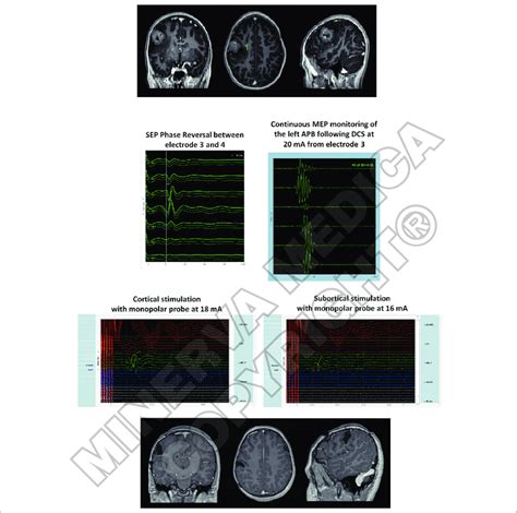 Illustrative Case Of Phase Reversal Cortical Mapping Mep Monitoring