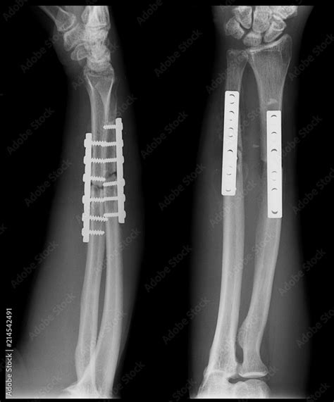 Fracture Bones Of Forearm Orthopedic Surgeon Operated And Internal