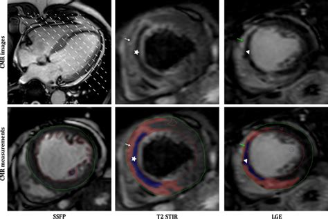 illustration of cmr measurements short axis slices were oriented on