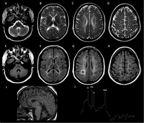 Clinical Characteristics Of The Ala21val Variant In The Myelin