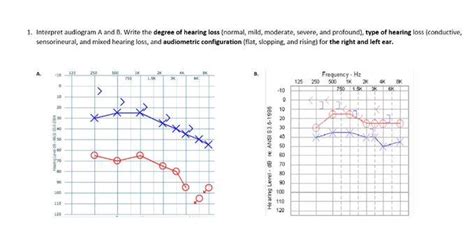 Profound Sensorineural Hearing Loss Audiogram