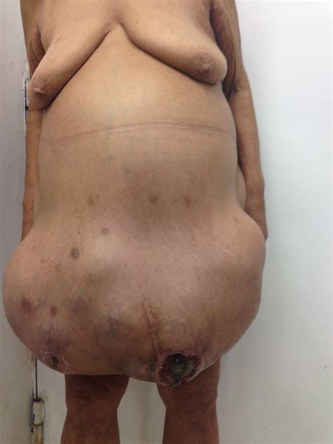 Virchow Node The Gastrointestinalatlasl