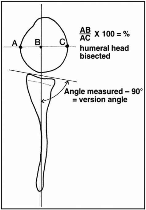 Schematic Drawing Showing The Method Of Measuring The Glenoid Version Download Scientific