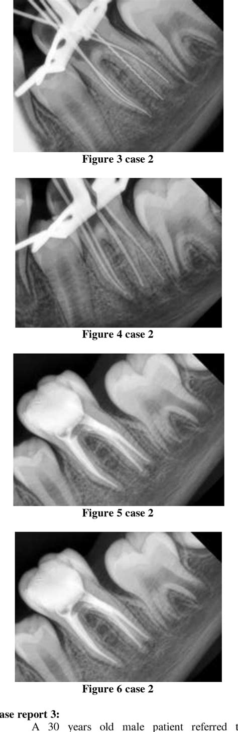 Figure 5 From Prevalence Of Radix Entomolaris In Mandibular First Molars In South Eastern