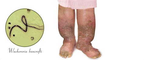 Filariasis Causes Symptoms Diagnosis And Treatment Faqs