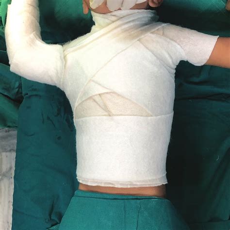 What Is A Shoulder Spica Wrap Used For At Jeremy Shockley Blog