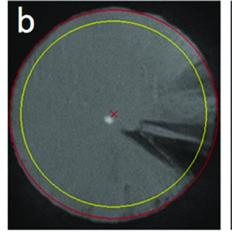 Kanazawa Medical University Cataract Classification And Grading System Download Scientific