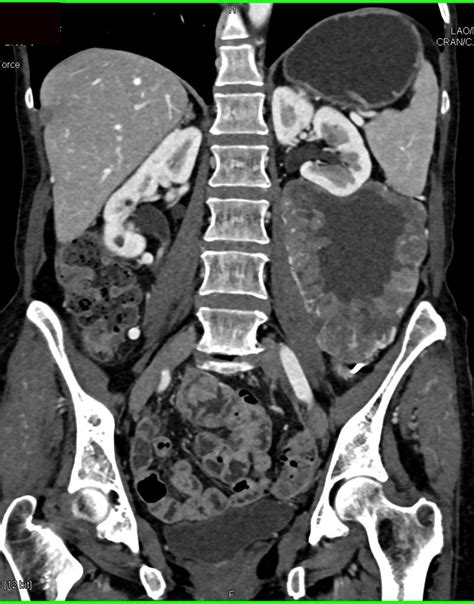 Large Gist Tumor With Neovascularity Gastrointestinal Radiology Case