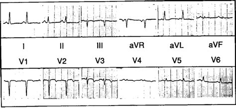 ECG From Case 1 Showing Severely Reduced R Wave Amplitude And T Wave Download Scientific