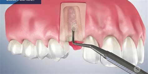 Extraction Socket Preservation When Why How