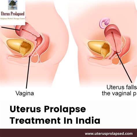 Uterus Prolapse Treatment In India