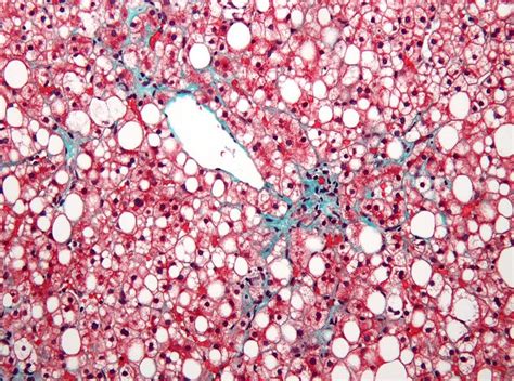 Intracellular Accumulations