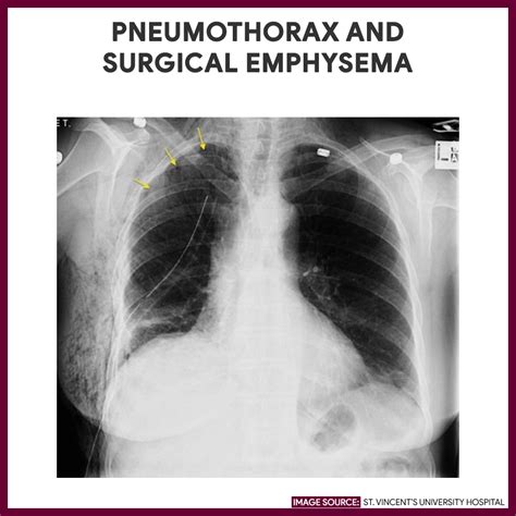 Chest X Ray Emphysema Findings