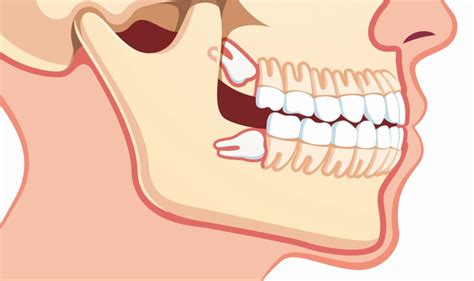 Quick Technique A New Paradigm For Third Molar Management Helsa Part