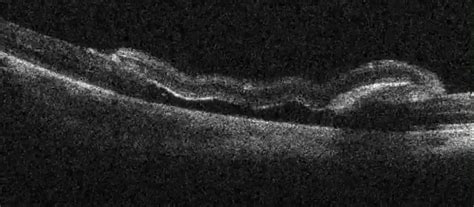 Clinical Advances Of Intraoperative Oct In Vitreoretinal Surgery Retinal Physician
