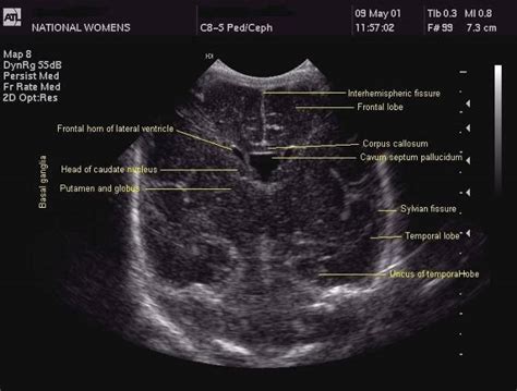 Intracranial Ultrasound 1800x1122