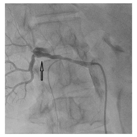 Right Renal Angiogram Showing Dissection Of The Right Renal Artery